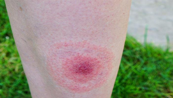 Researchers discover new therapeutic target for Lyme disease