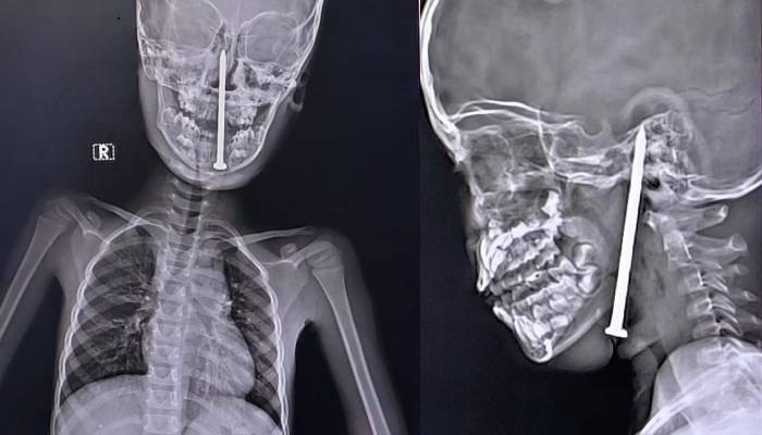 Miracle surgery saves seven-year-old boy after 8cm nail enters brain