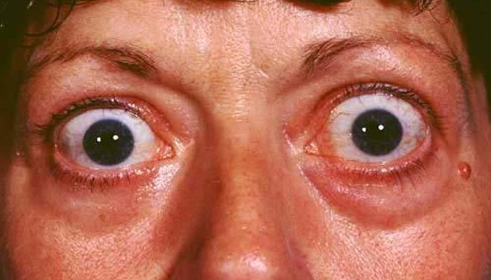 What is Graves disease? Signs, symptoms and treatment